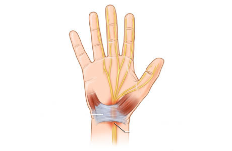 ΣΥΝΔΡΟΜΟ ΚΑΡΠΙΑΙΟΥ ΣΩΛΗΝΑ - Κωνσταντίνος Κωτσιόπουλος